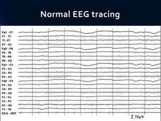 EEG of Children and Sleep | PPTX