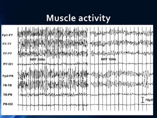 EEG of Children and Sleep | PPTX