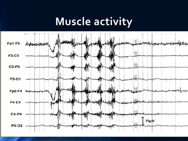 EEG of Children and Sleep | PPTX | Parenting Babies and Toddlers ...