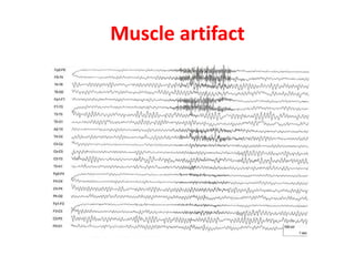 EEG Artifacts | PPTX