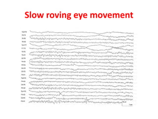 EEG Artifacts | PPTX