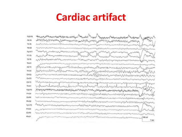 EEG Artifacts | PPT