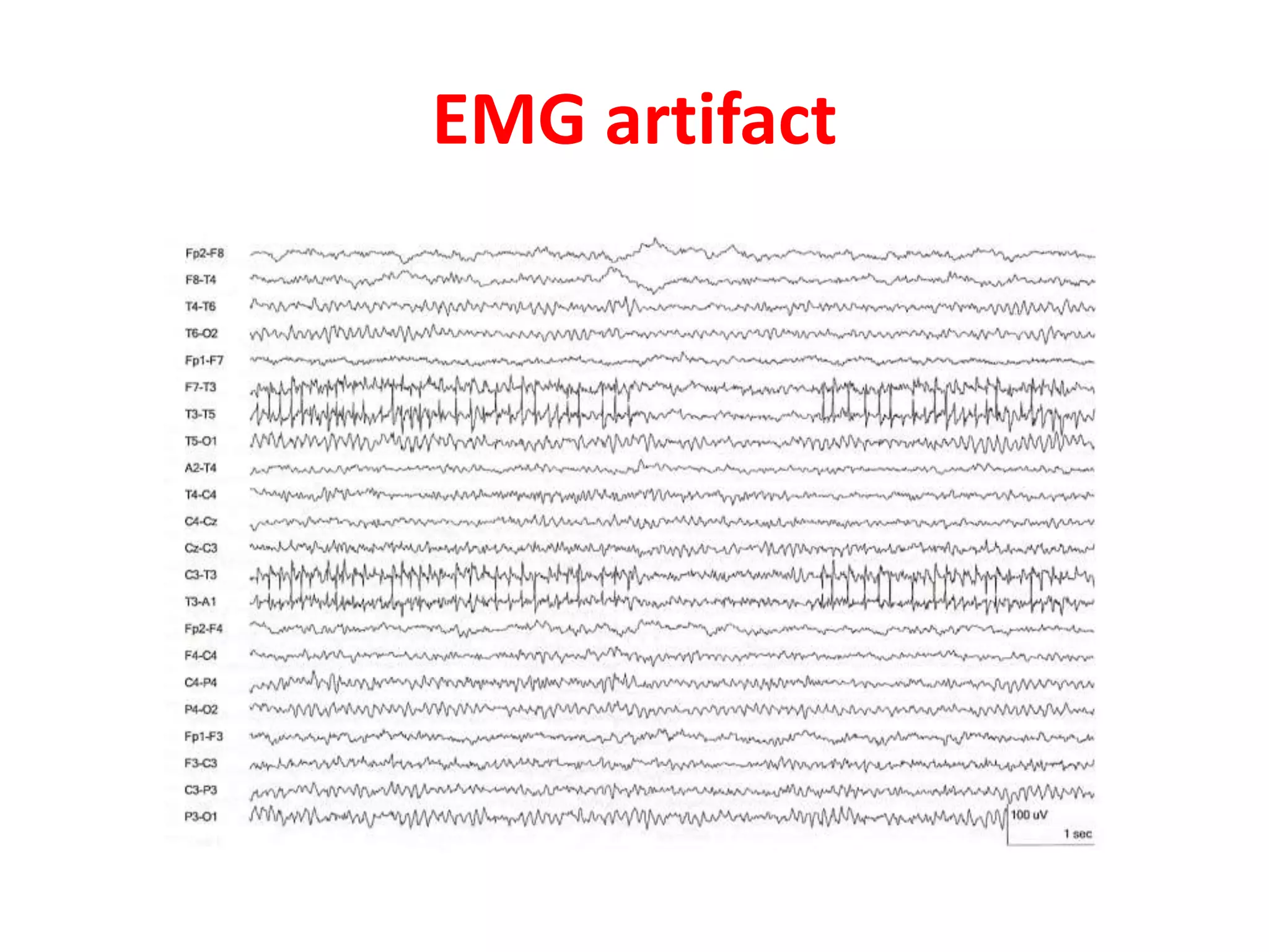 EEG artifacts | PPTX