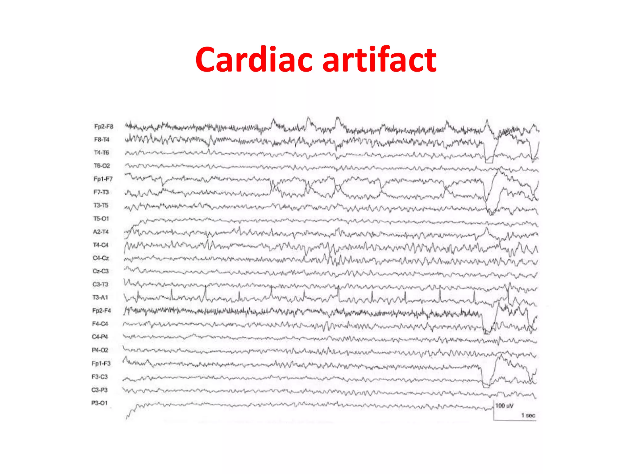 EEG artifacts | PPTX
