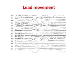 EEG artifacts | PPTX