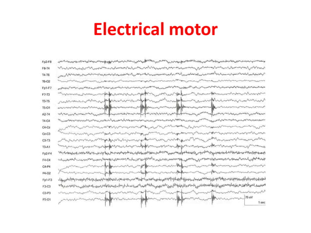 Eeg Artifacts Ppt