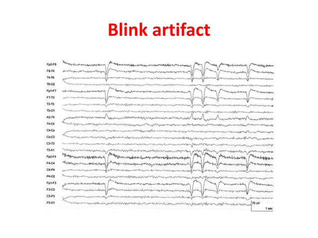 Eeg Artifacts Ppt