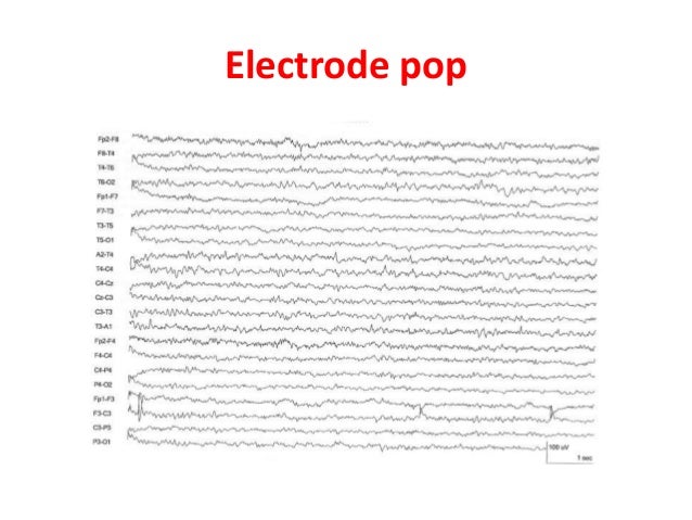 EEG artifacts