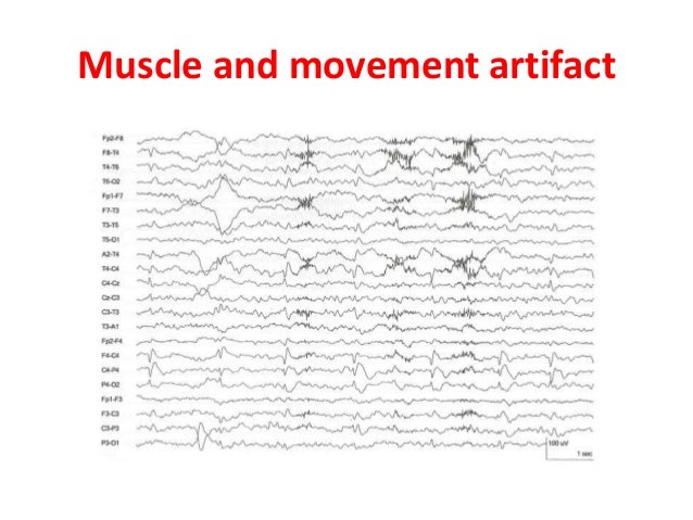 EEG artifacts