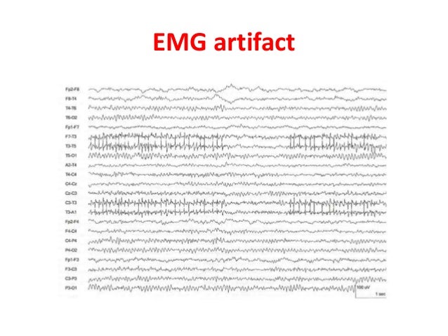 Eeg Artifact