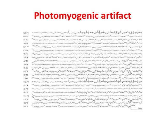 EEG artifacts