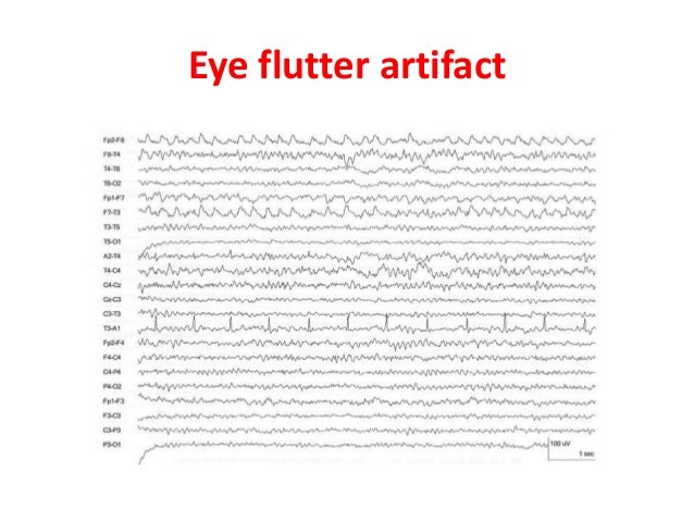 EEG artifacts