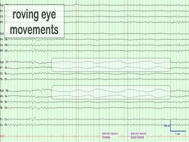EEG artifacts 2