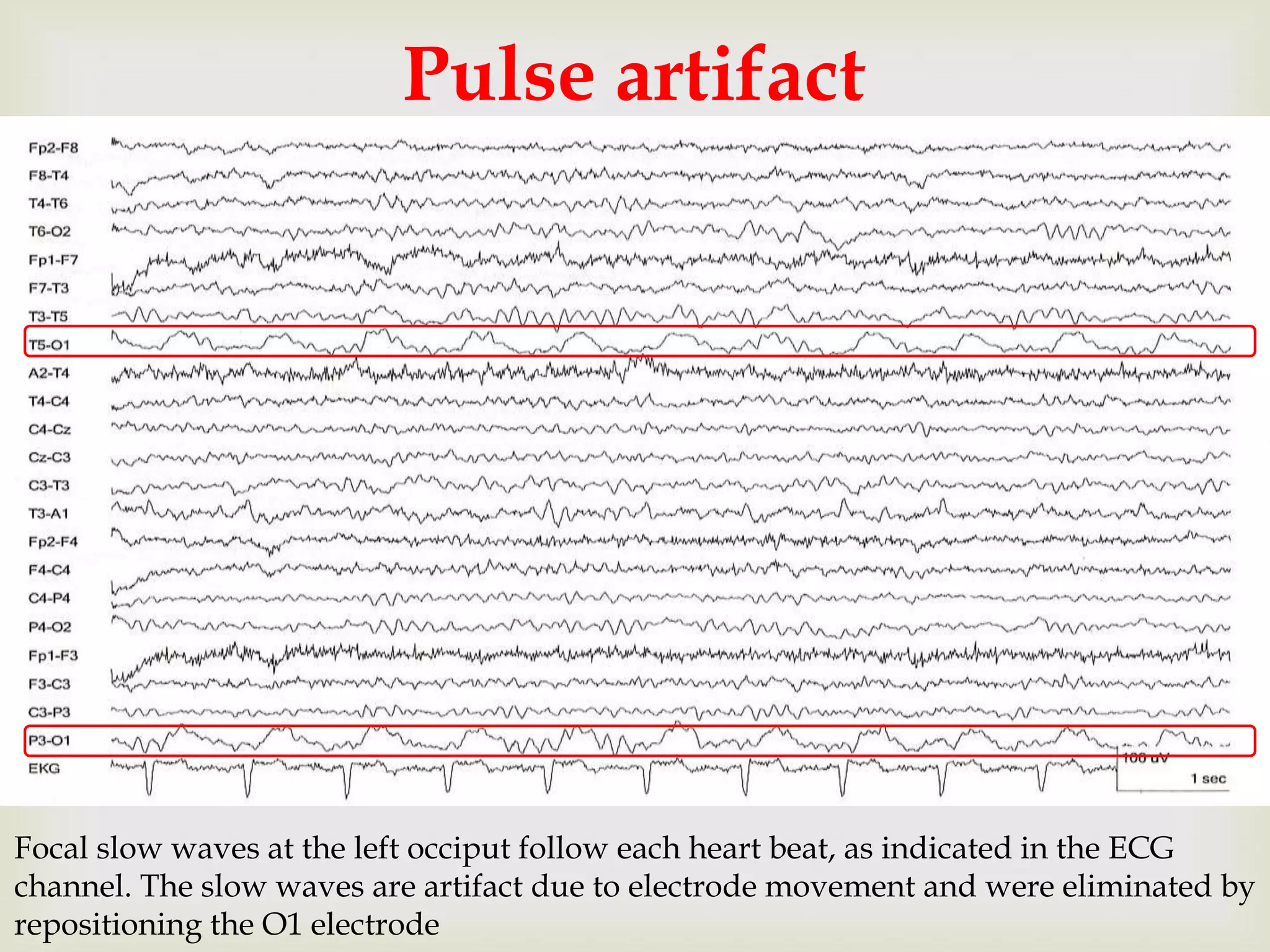 EEG artifacts | PPTX