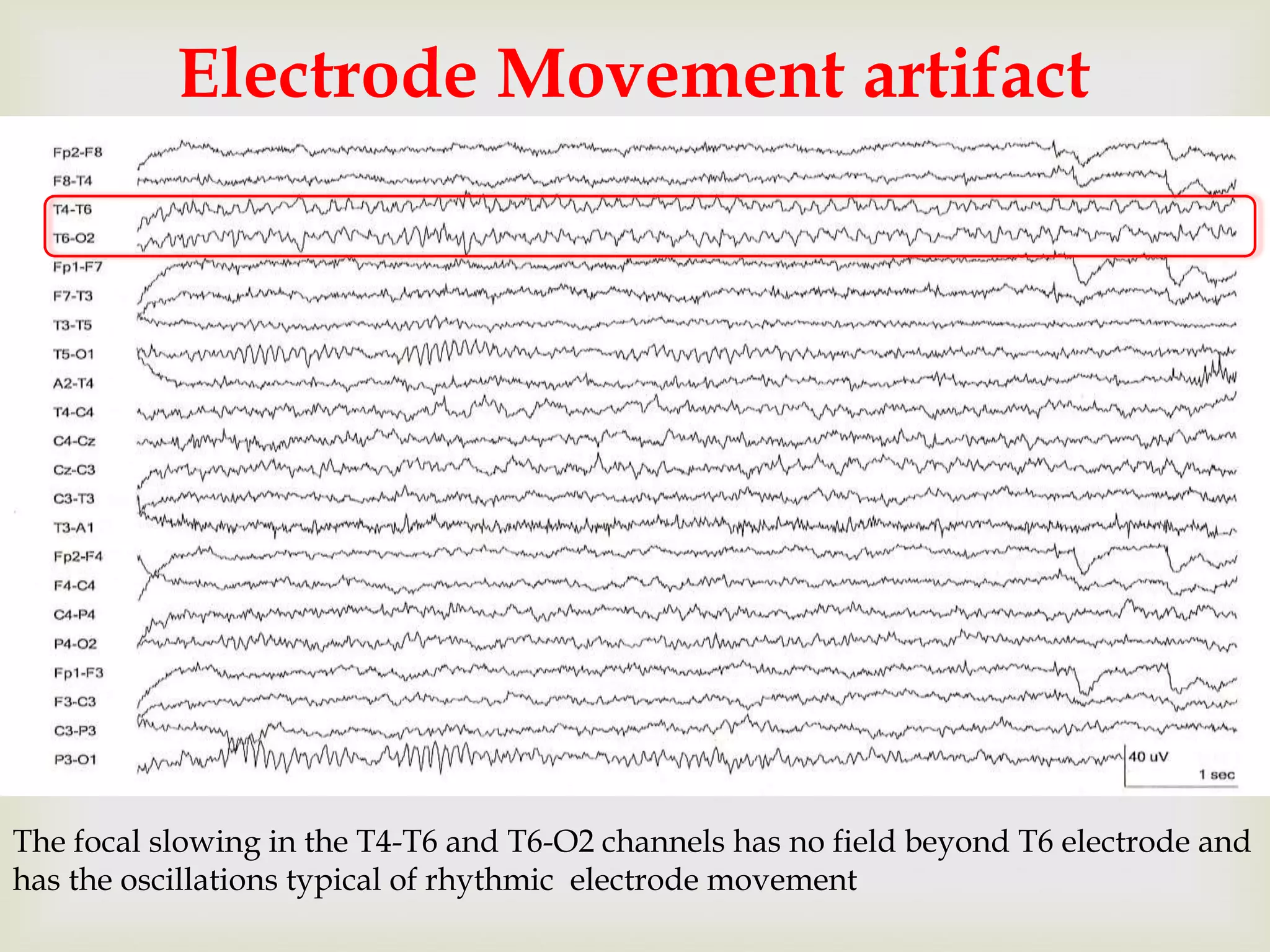 EEG artifacts | PPTX