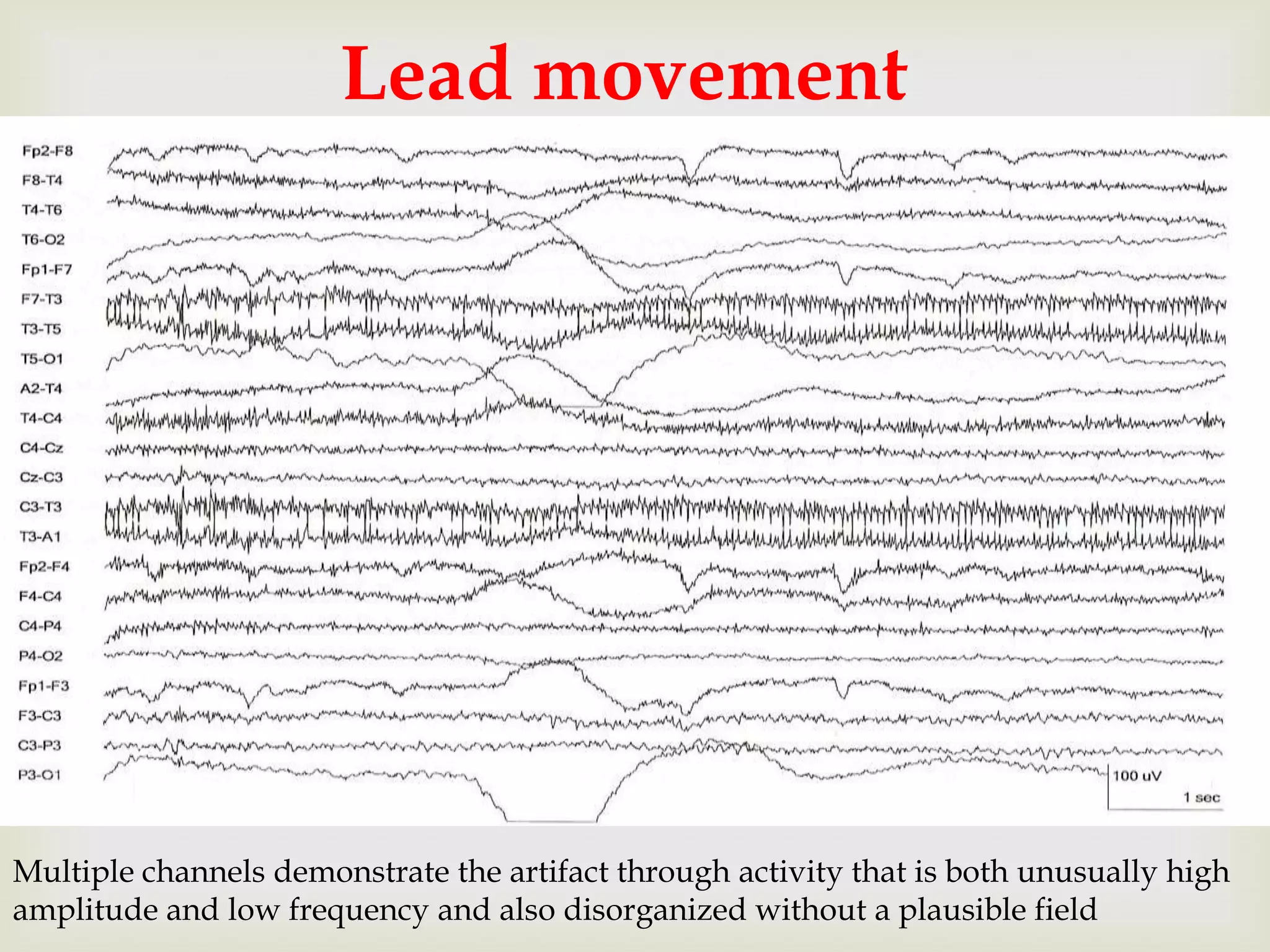 EEG artifacts | PPTX
