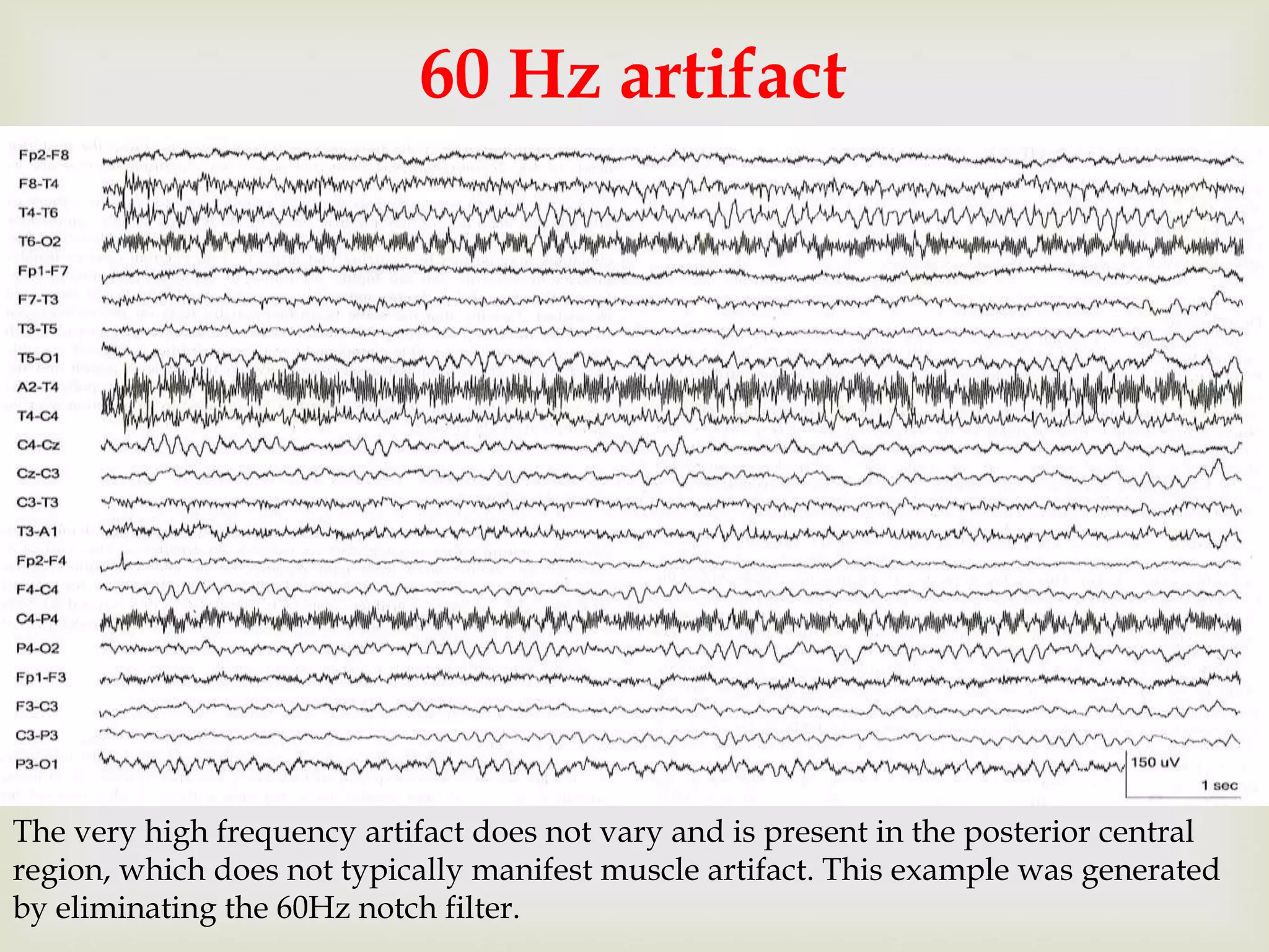 EEG artifacts | PPTX