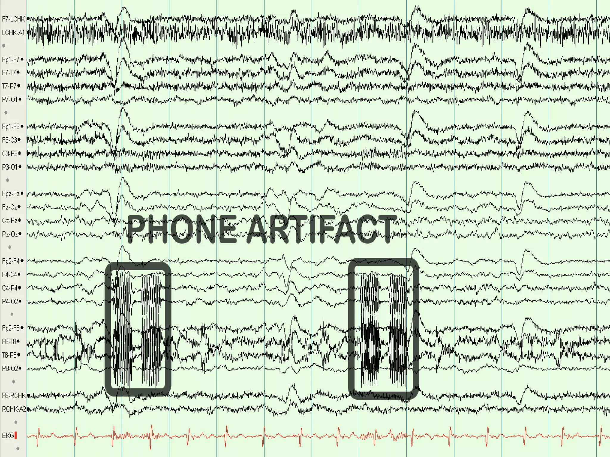 EEG artifacts | PPTX