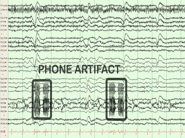 EEG artifacts | PPTX