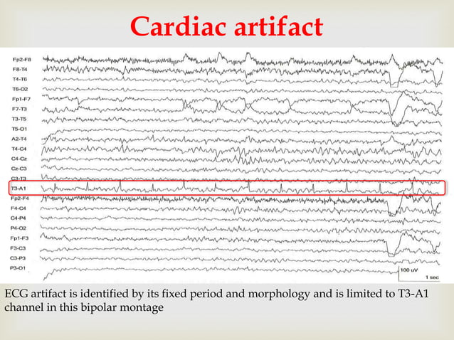 EEG artifacts | PPTX