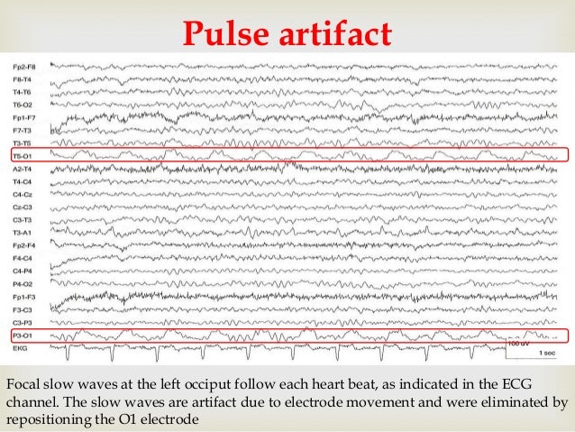 EEG artifacts