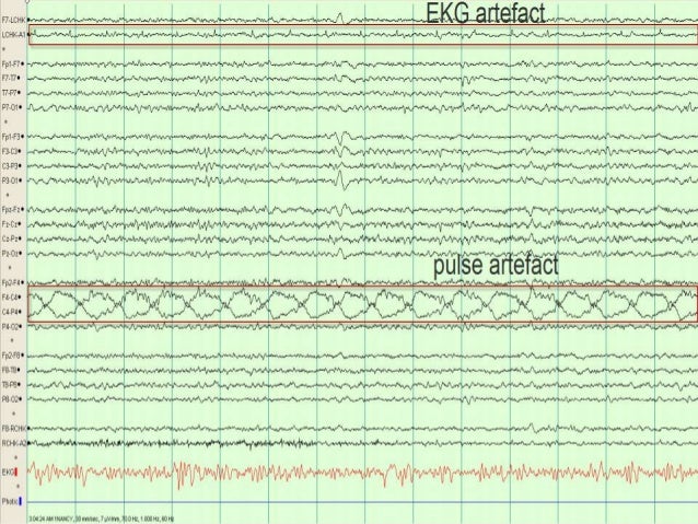 EEG artifacts