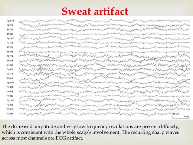 EEG artifacts