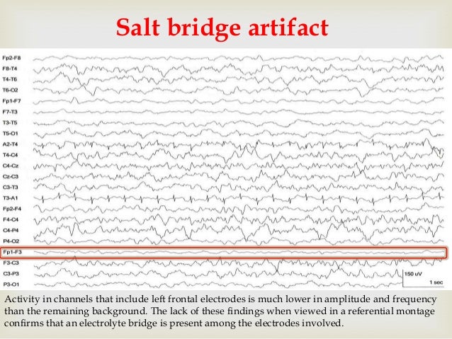 EEG artifacts