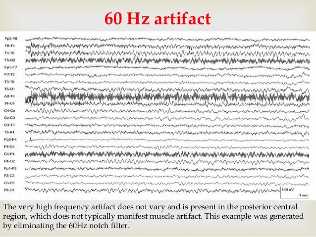 EEG artifacts