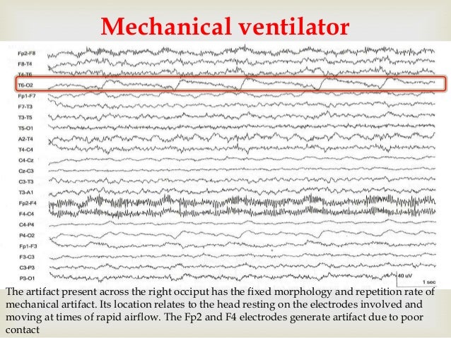 EEG artifacts