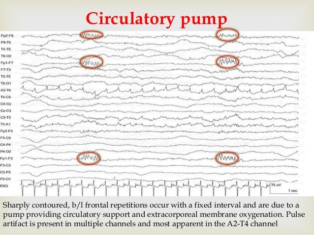 EEG artifacts