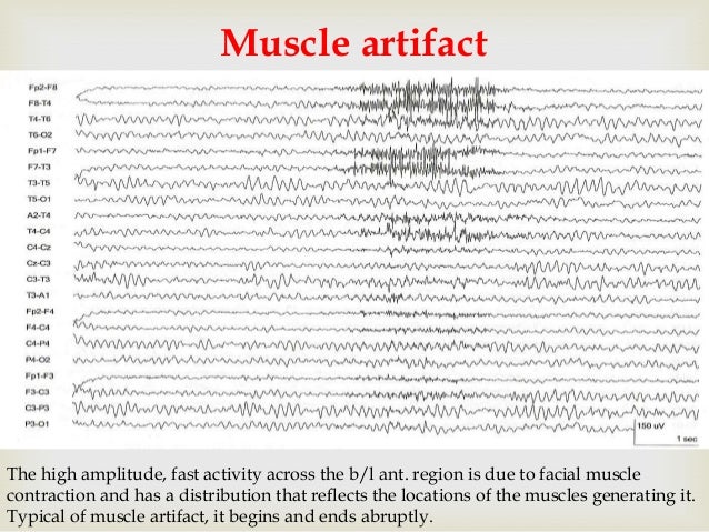 EEG artifacts