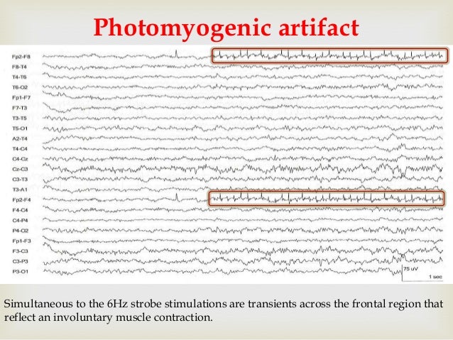 EEG artifacts