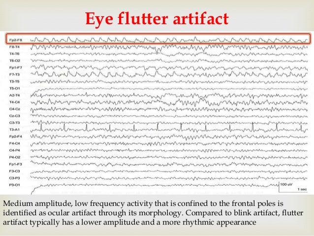 EEG artifacts