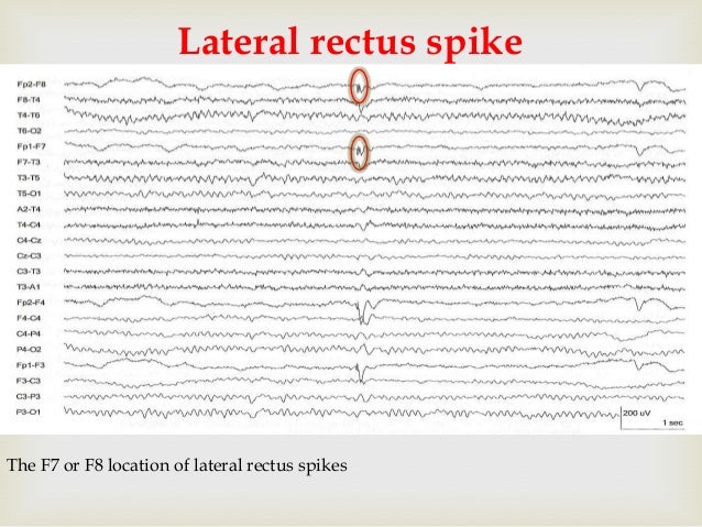 EEG artifacts