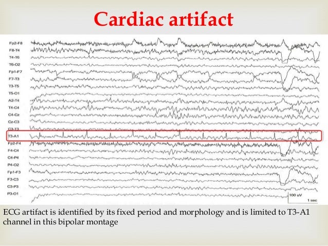 Eeg Artifact
