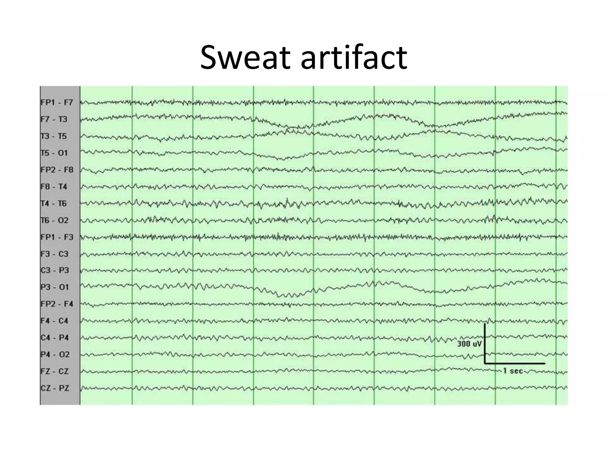 Eeg artifacts | PPTX