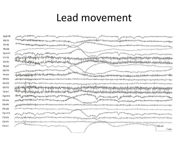 Eeg artifacts | PPTX | Science