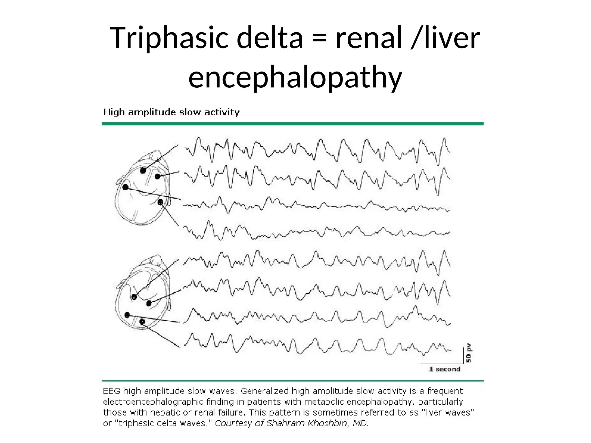 EEG interpretation for healthcare workers.ppt