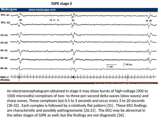 EEG interpretation for healthcare workers.ppt