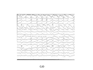 EEG interpretation for healthcare workers.ppt