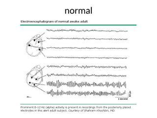 EEG interpretation for healthcare workers.ppt
