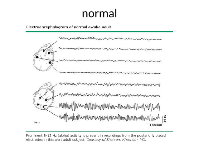 EEG interpretation for healthcare workers.ppt
