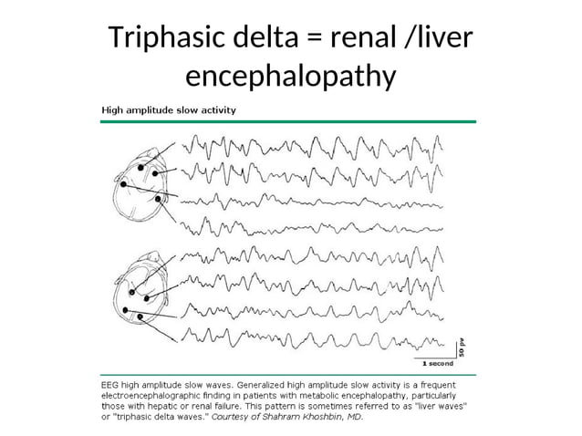 EEG interpretation for healthcare workers.ppt