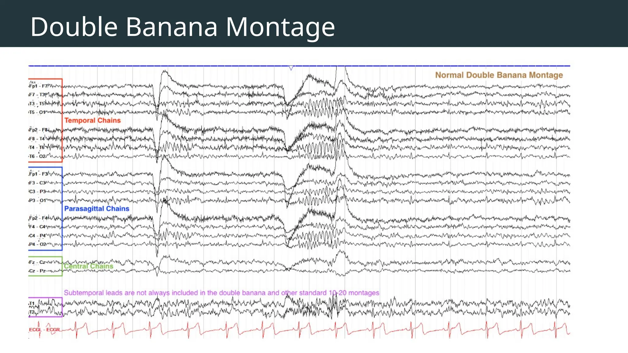 EEG Basics for Beginners with pictures and tex | PPTX