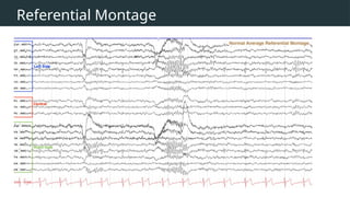 EEG Basics for Beginners with pictures and tex | PPTX