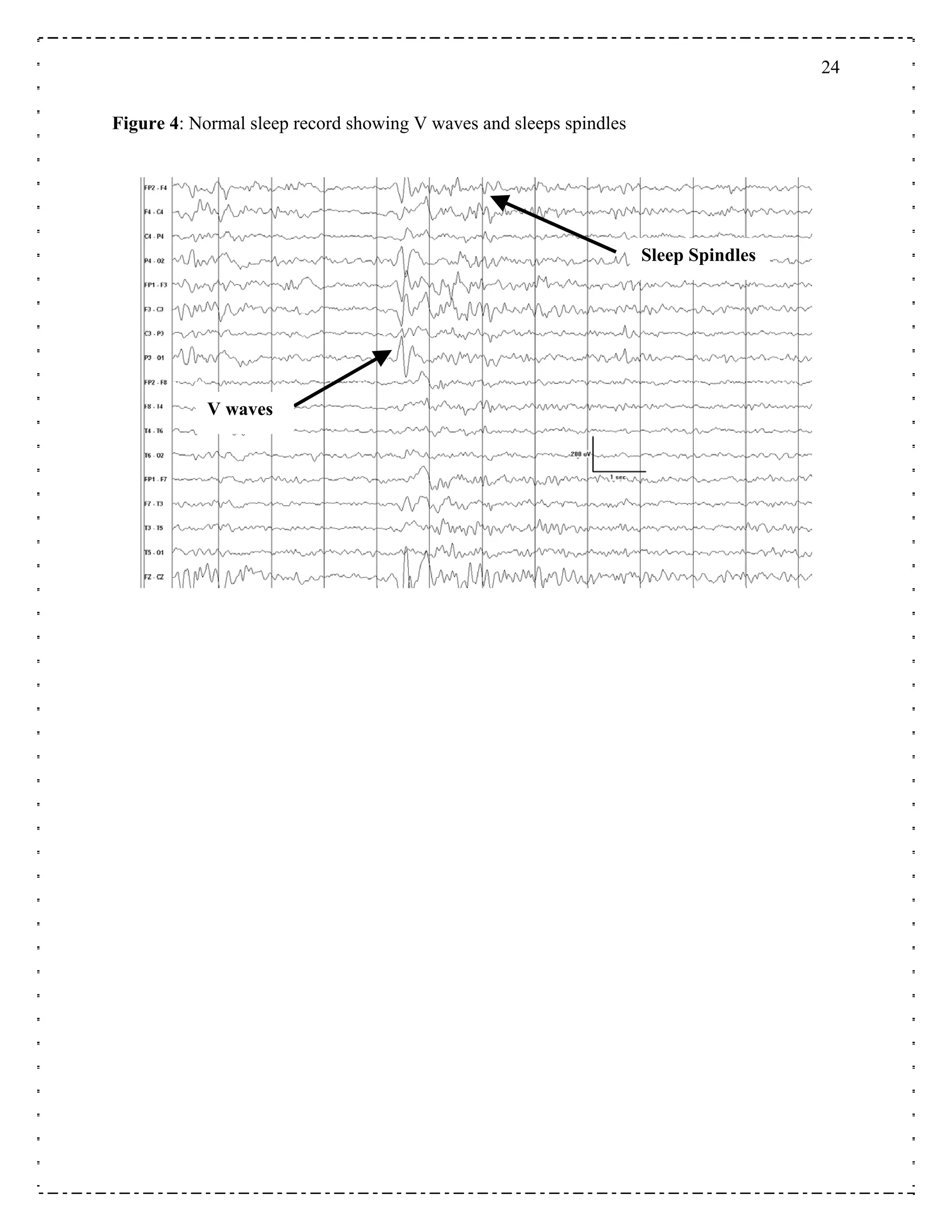 Pediatric EEG - by Dr.Rajesh Ramachandran Nair | PDF