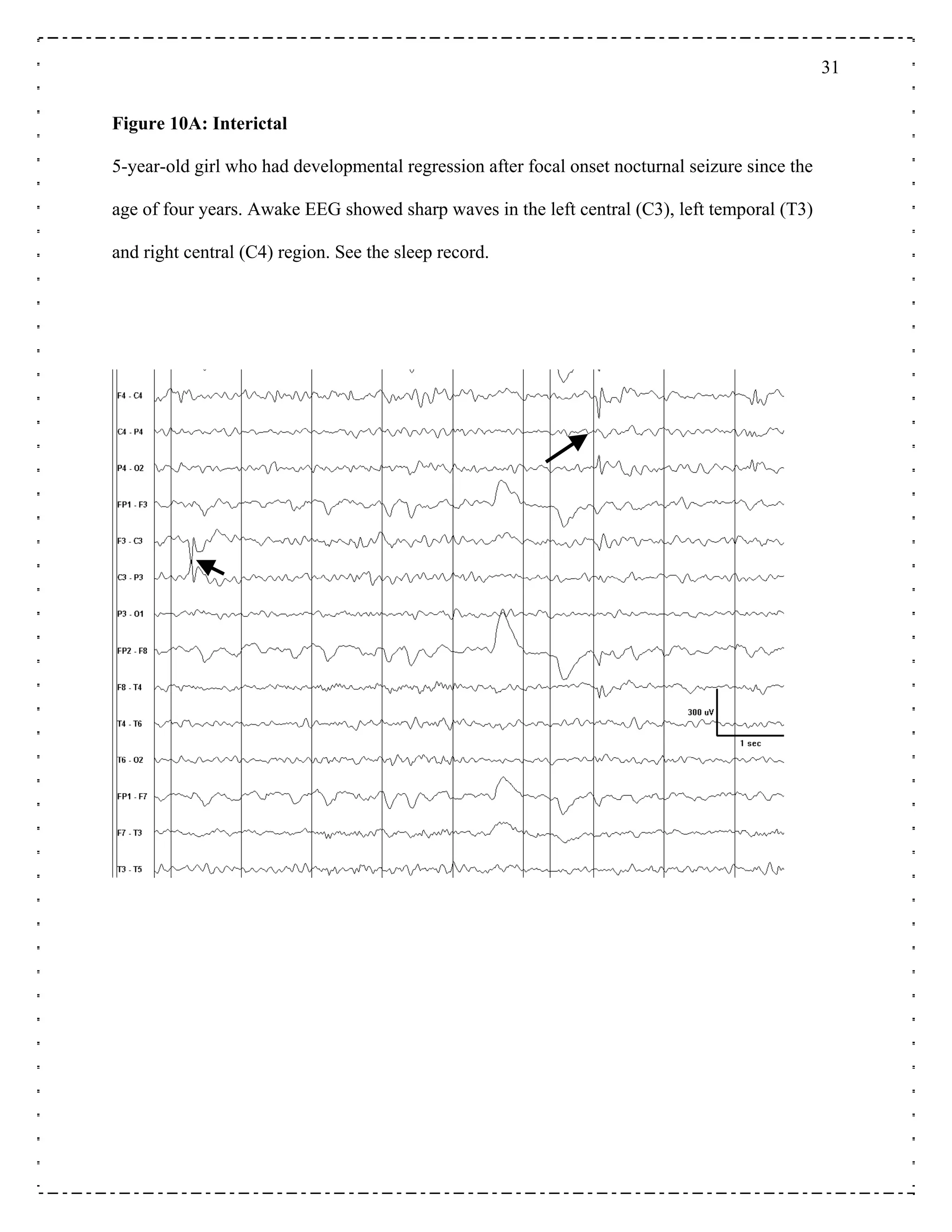 Pediatric EEG - by Dr.Rajesh Ramachandran Nair | PDF