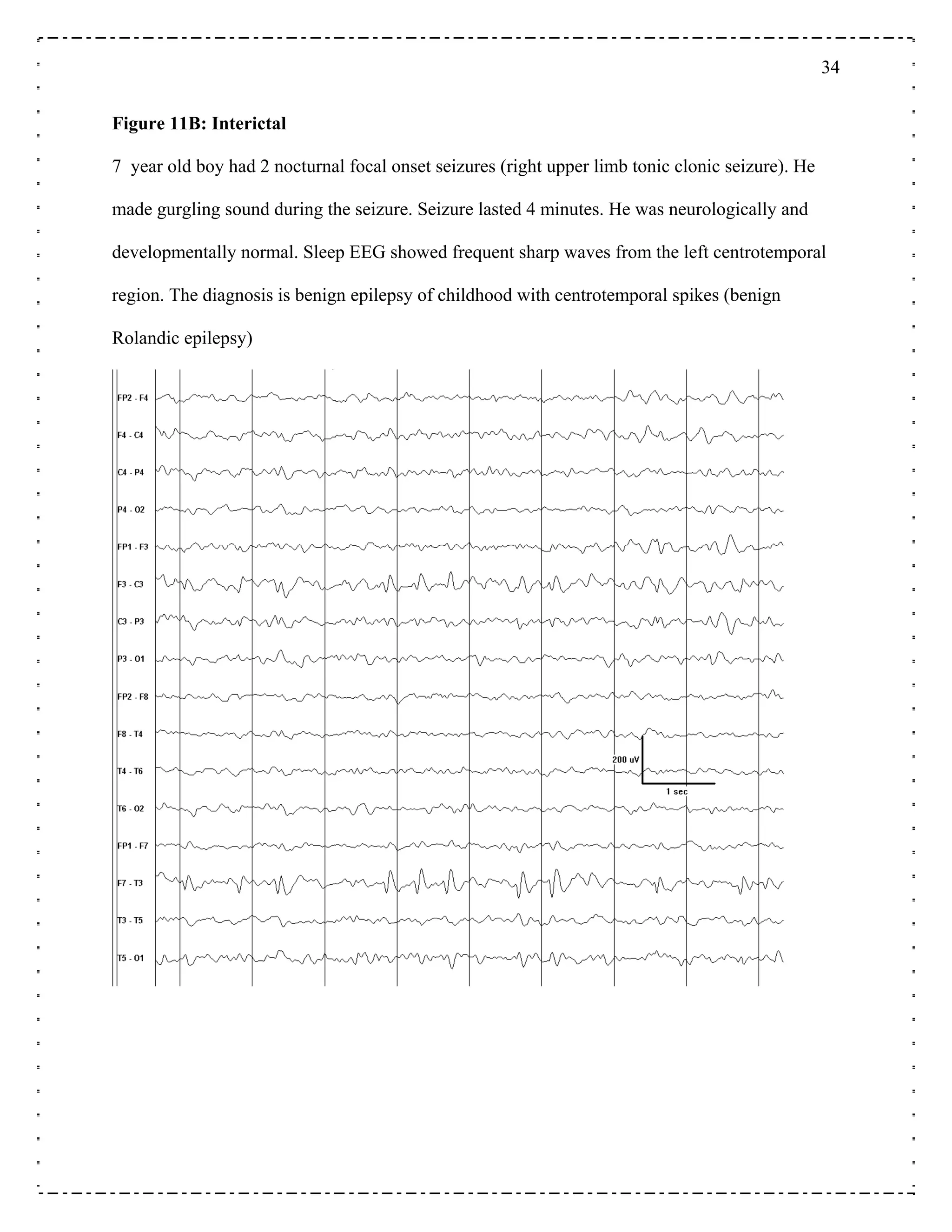 Pediatric EEG - by Dr.Rajesh Ramachandran Nair | PDF