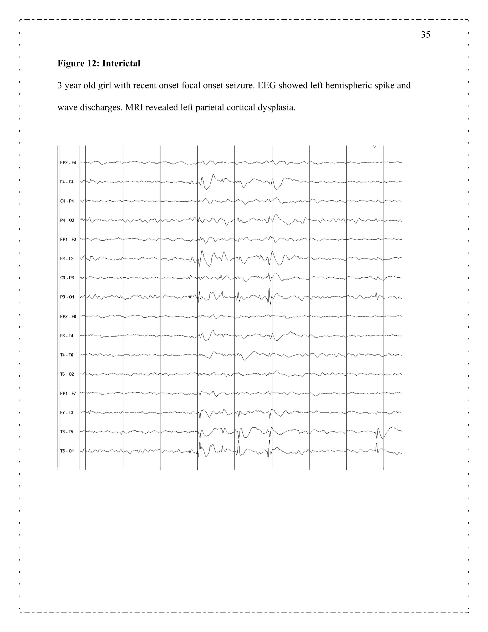 Pediatric EEG - by Dr.Rajesh Ramachandran Nair | PDF